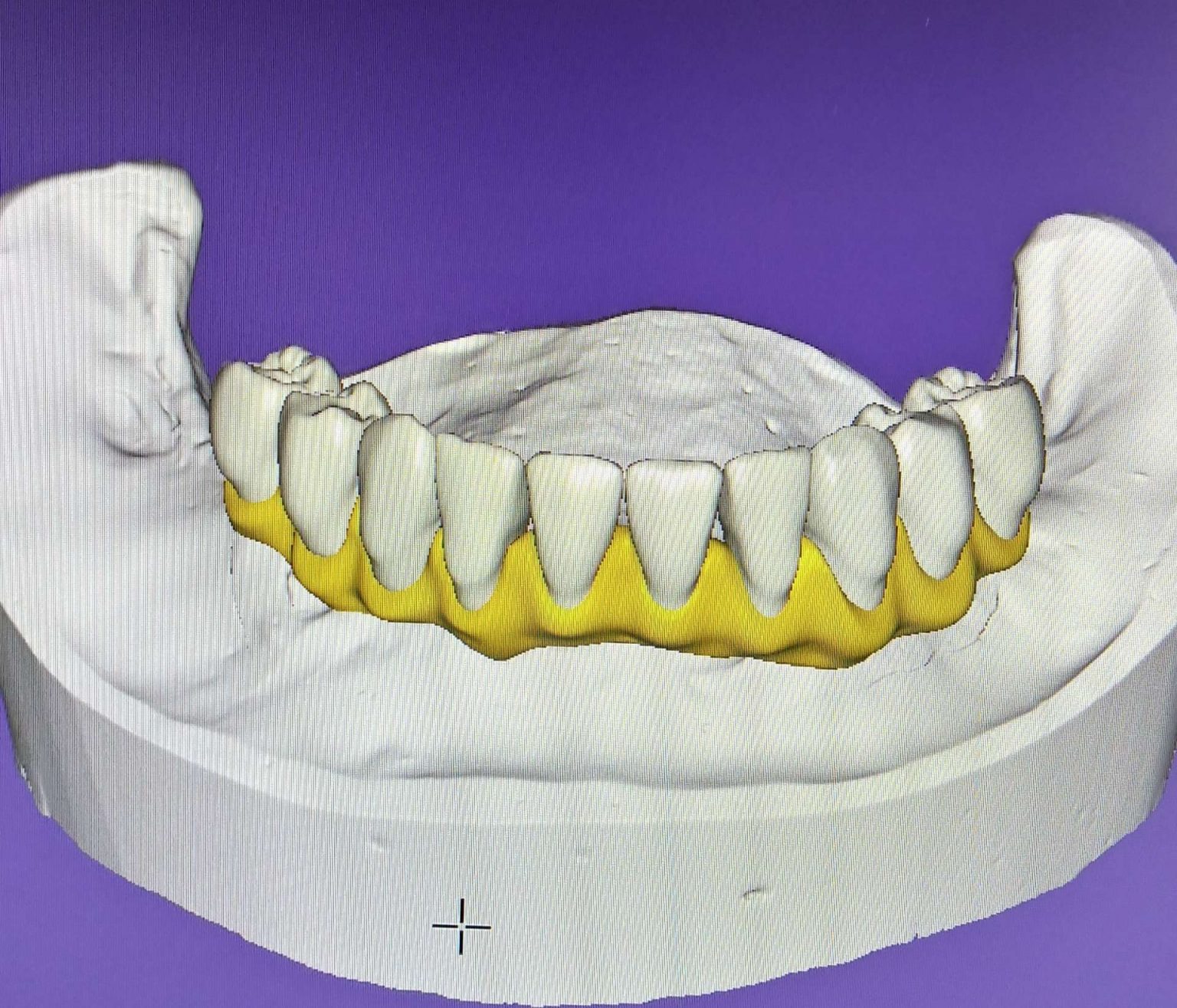 Toronto bridge inferiore - Dental Project