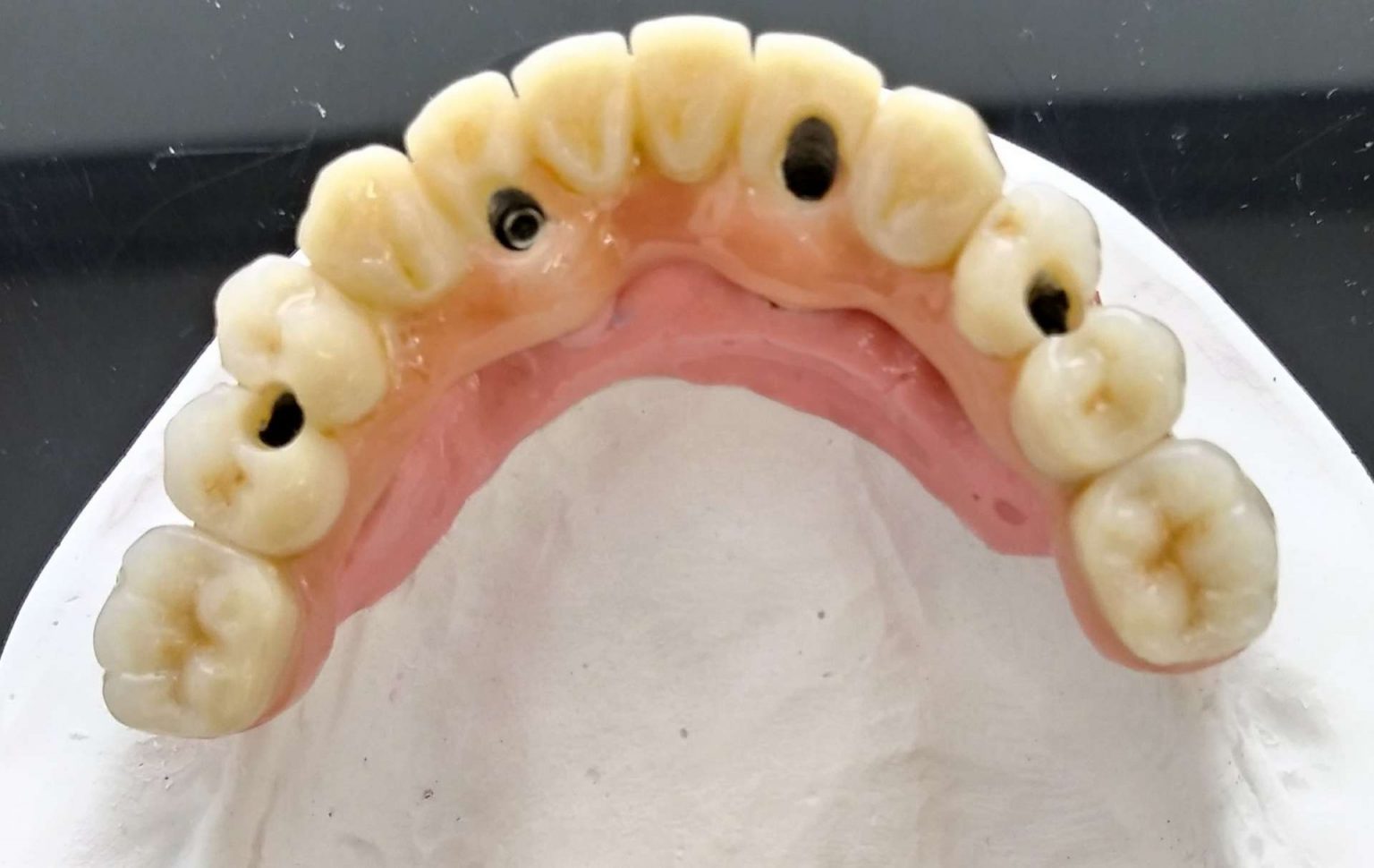 Toronto bridge inferiore - Dental Project